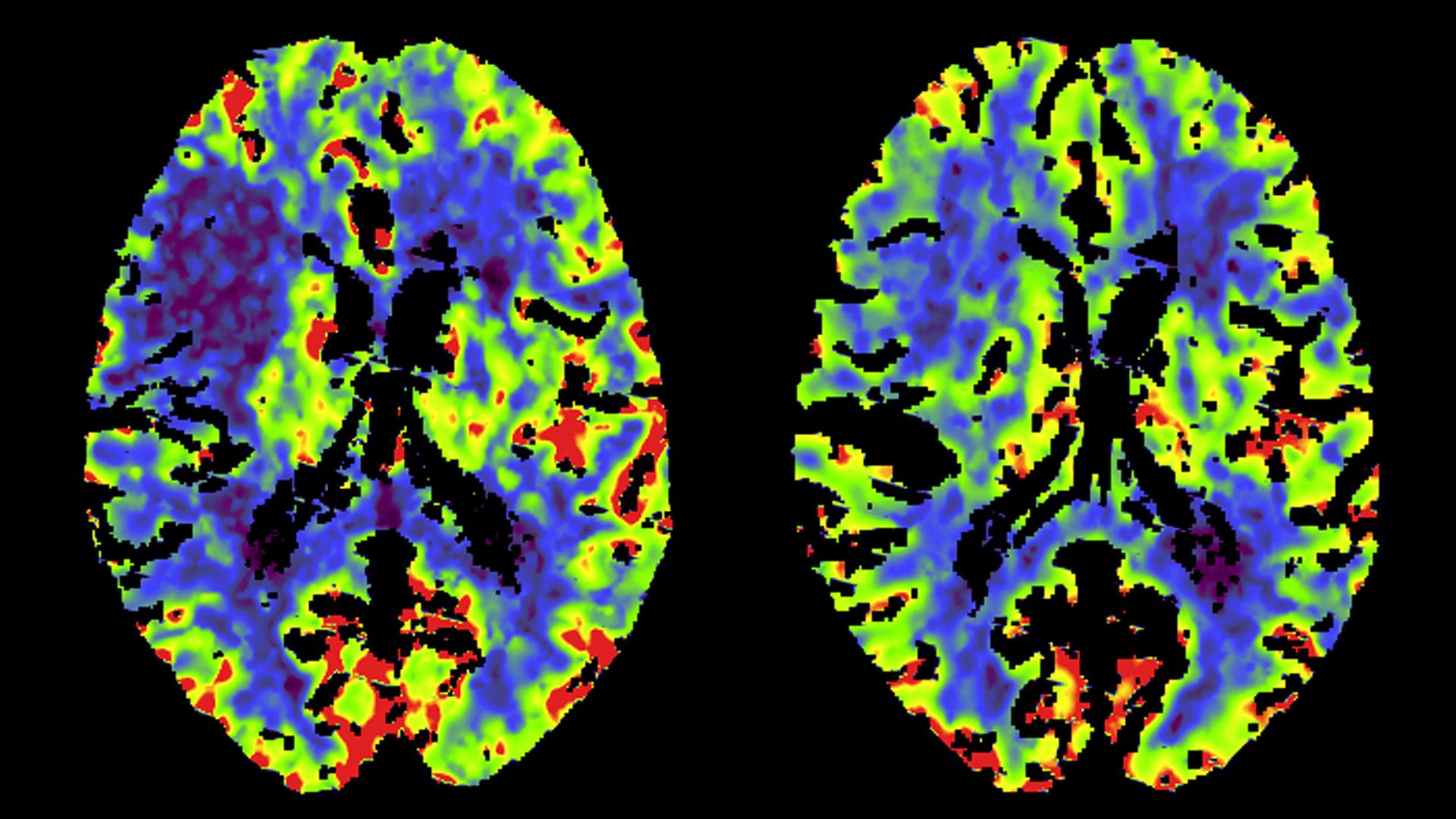 Acute Ischemic Stroke – Cerebral Perfusion prior to and after Treatment