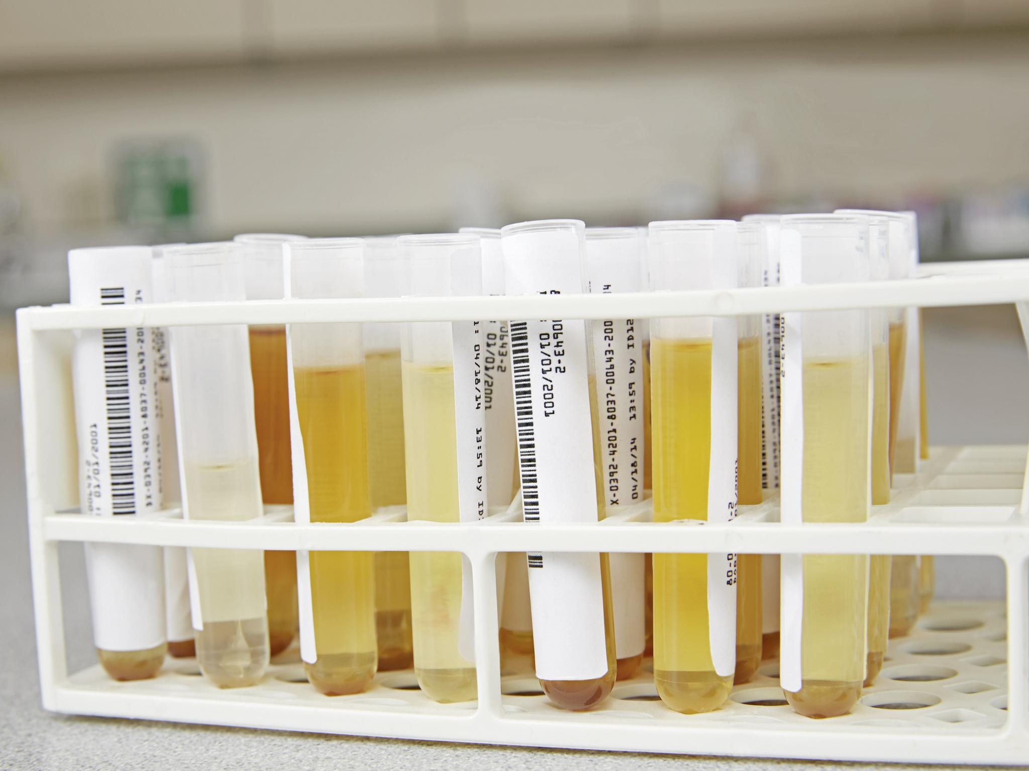 Drugs of Abuse Assays - Siemens Healthineers