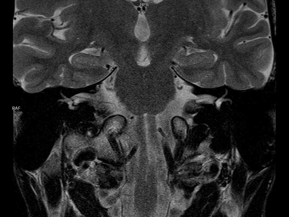 Coronal T2 tse-MAGNETOM Altea - Siemens Healthineers USA