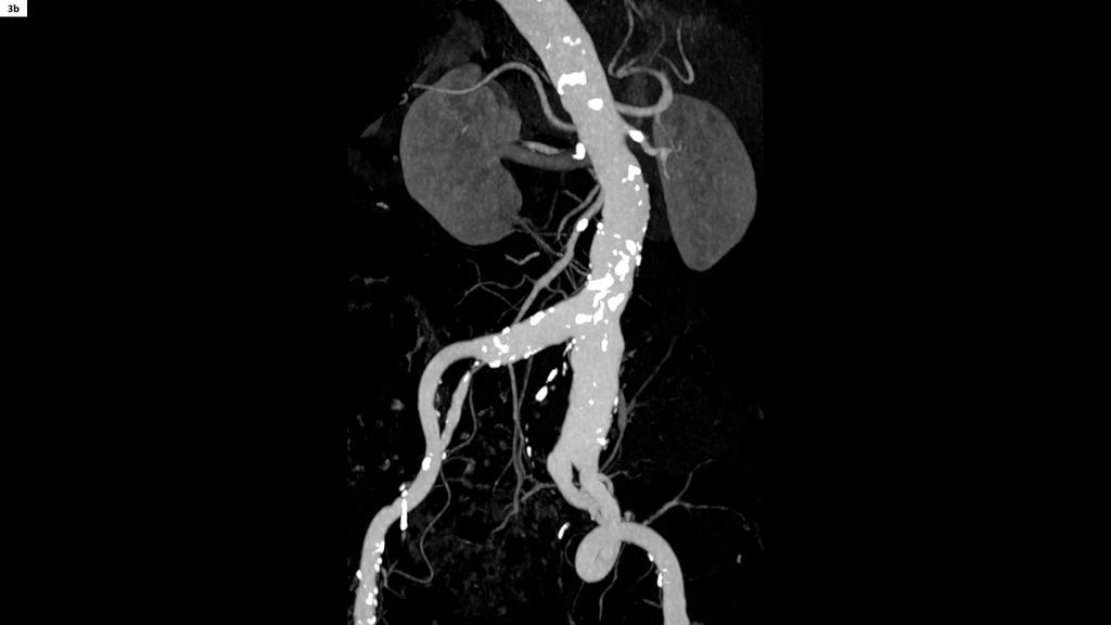 Isolated Common Iliac Artery Aneurysm - Siemens Healthineers USA