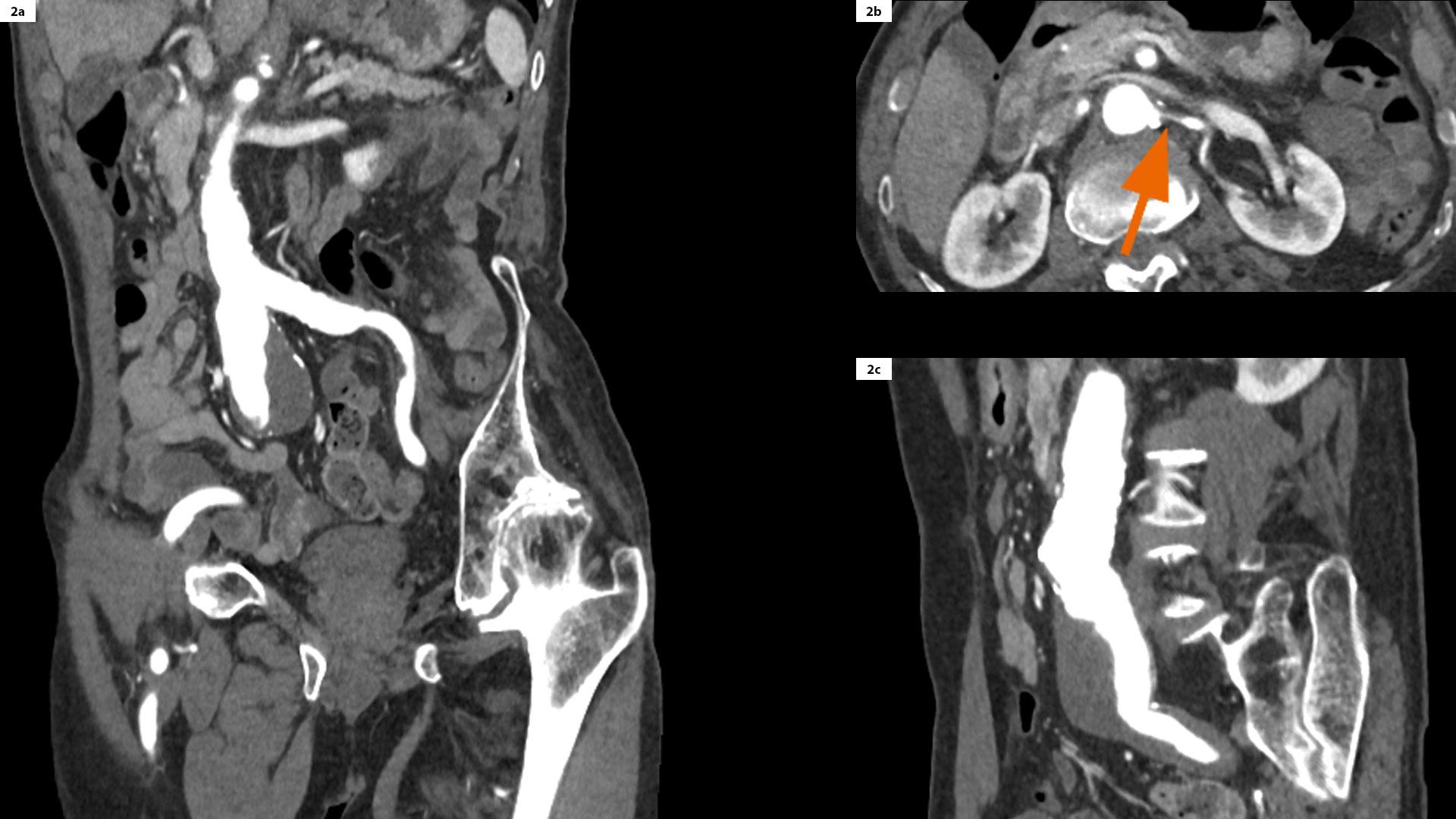 Isolated Common Iliac Artery Aneurysm - Siemens Healthineers USA