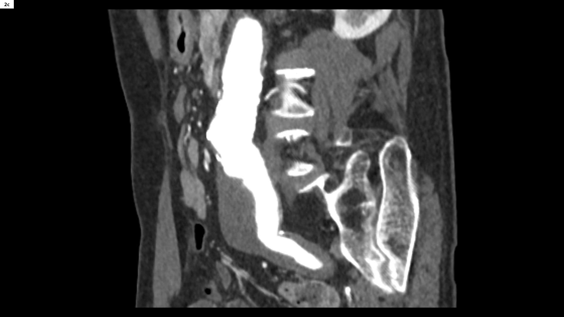 Isolated Common Iliac Artery Aneurysm - Siemens Healthineers USA