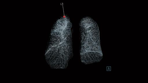 AI-Rad Companion - Siemens Healthineers USA