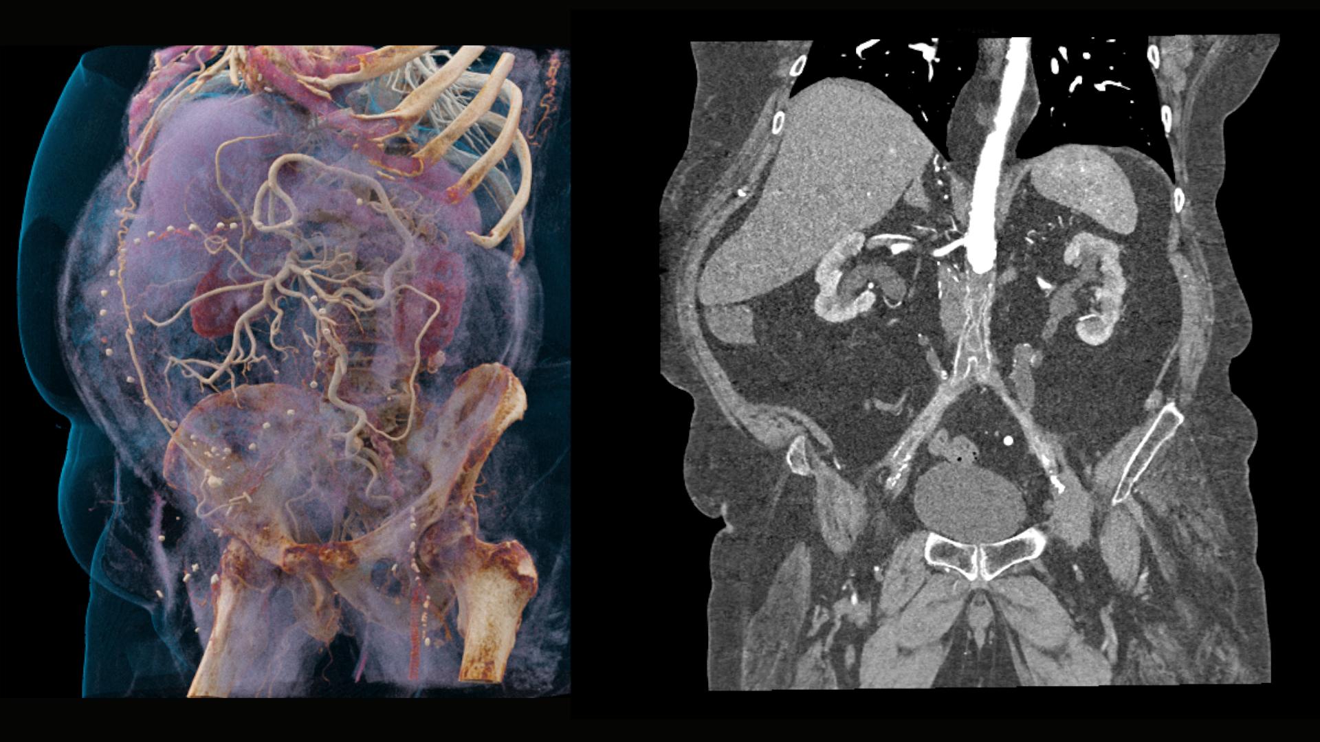 SOMATOM go.Top with myExam Companion - Siemens Healthineers India