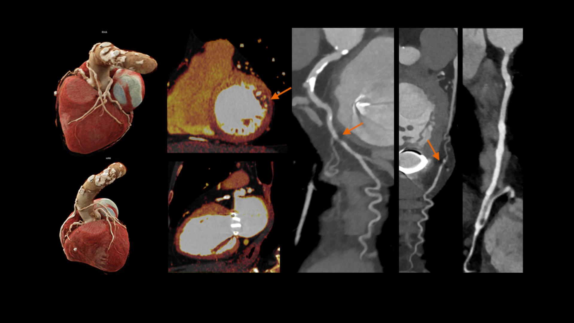 Dual Source CT - Siemens Healthineers