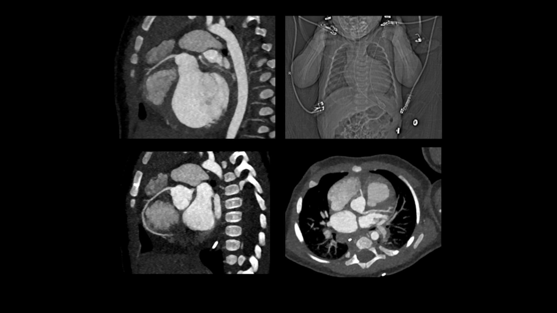 Dual Source CT Siemens Healthineers Italia