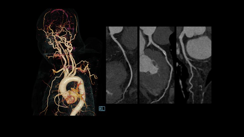 Dual Source CT Siemens Healthineers Italia