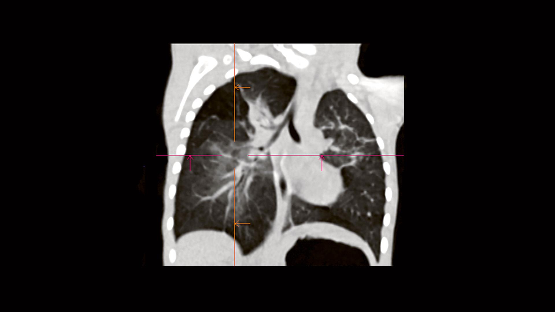 Dual Source CT Siemens Healthineers Italia