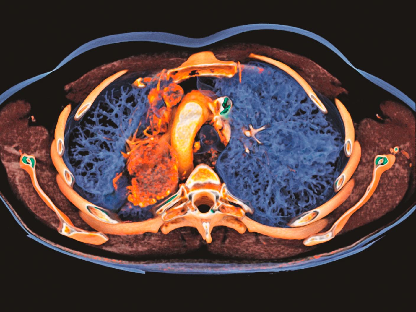 Computed Tomography for Oncology