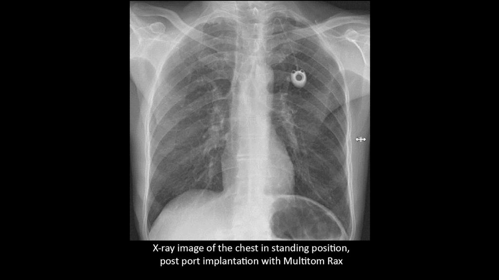Twin Robotic X-ray scanner – Multitom Rax - Siemens Healthineers Sverige