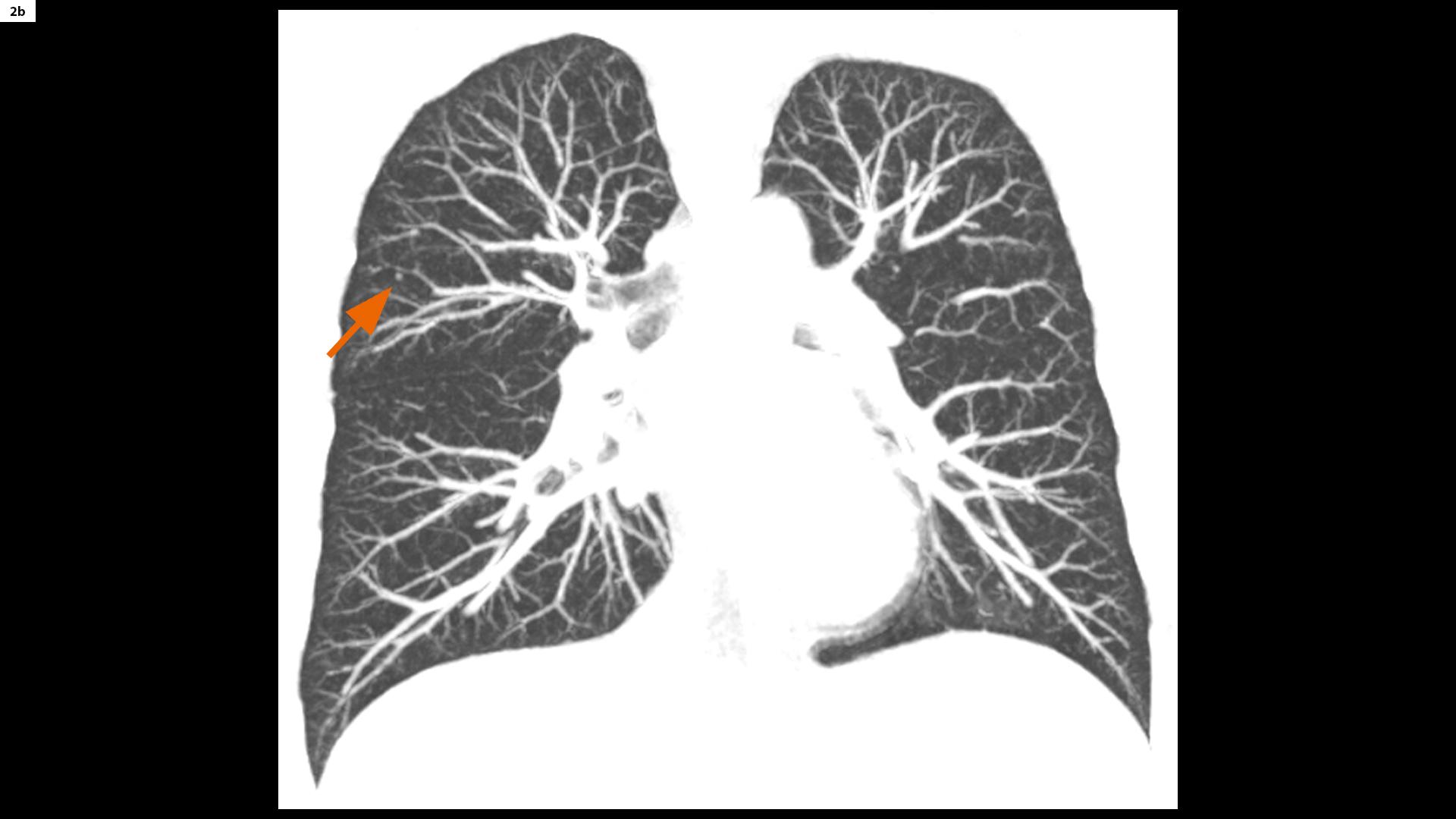 A Solitary Pulmonary Micronodule in Melanoma Staging – Metastasis ...