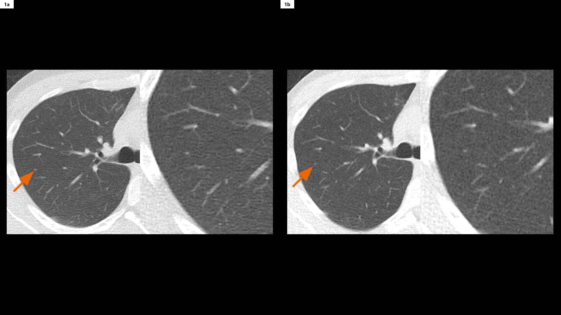 A Solitary Pulmonary Micronodule in Melanoma Staging – Metastasis?