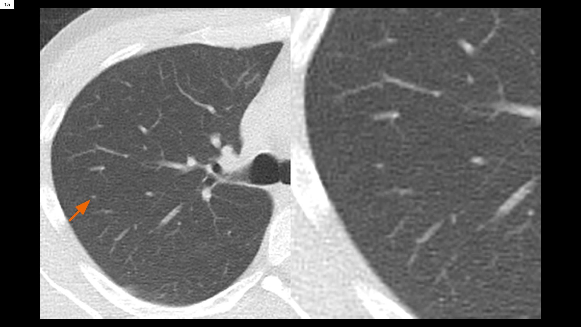 A Solitary Pulmonary Micronodule in Melanoma Staging – Metastasis?