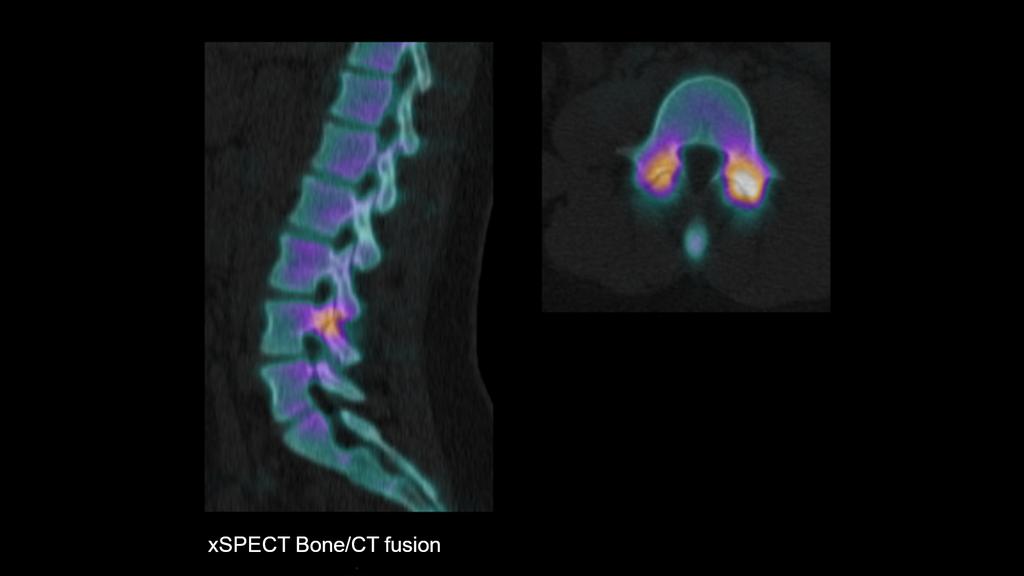 Symbia Intevo Bold - Siemens Healthineers Indonesia