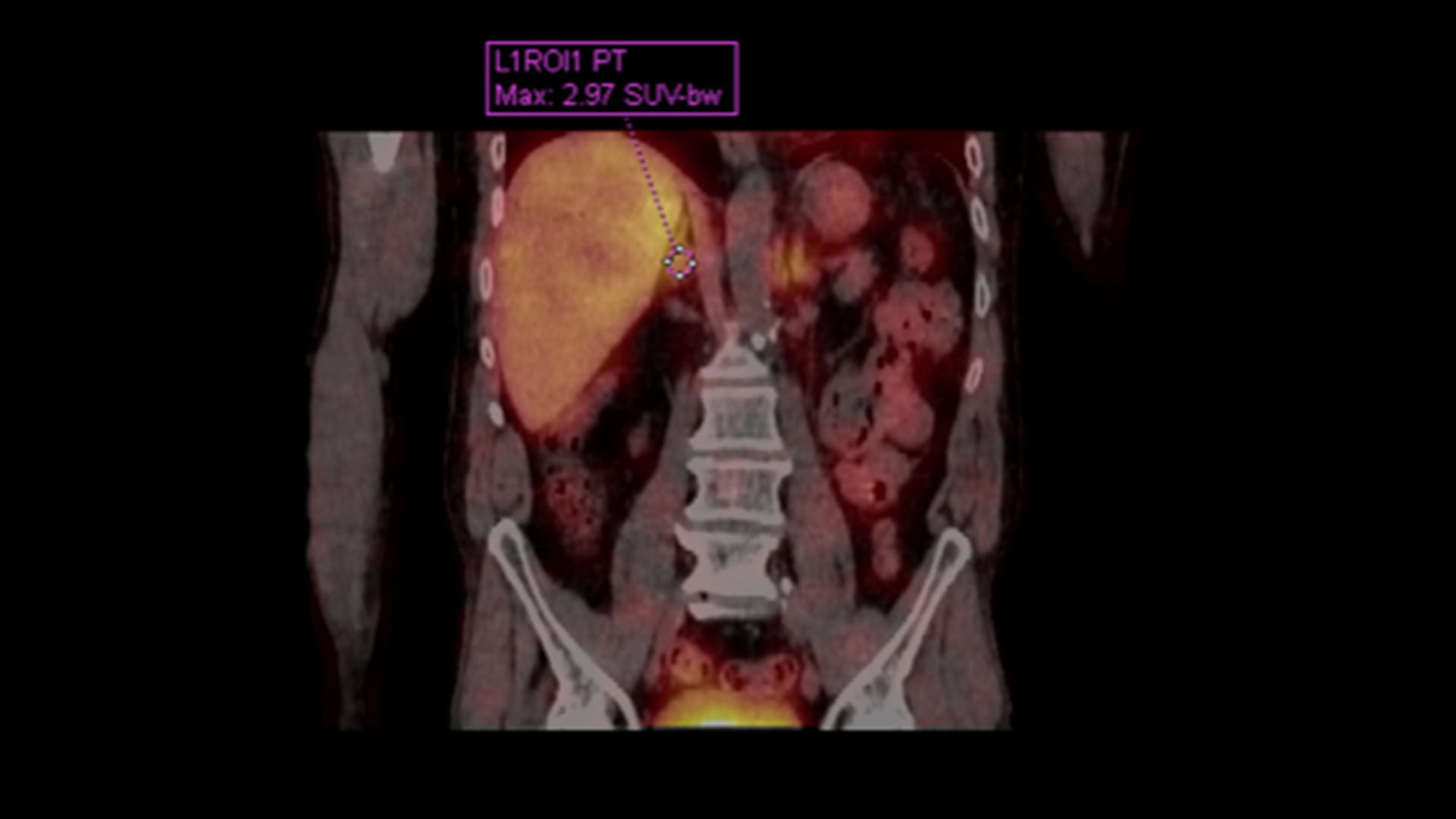 Symbia Intevo Bold - Siemens Healthineers Indonesia