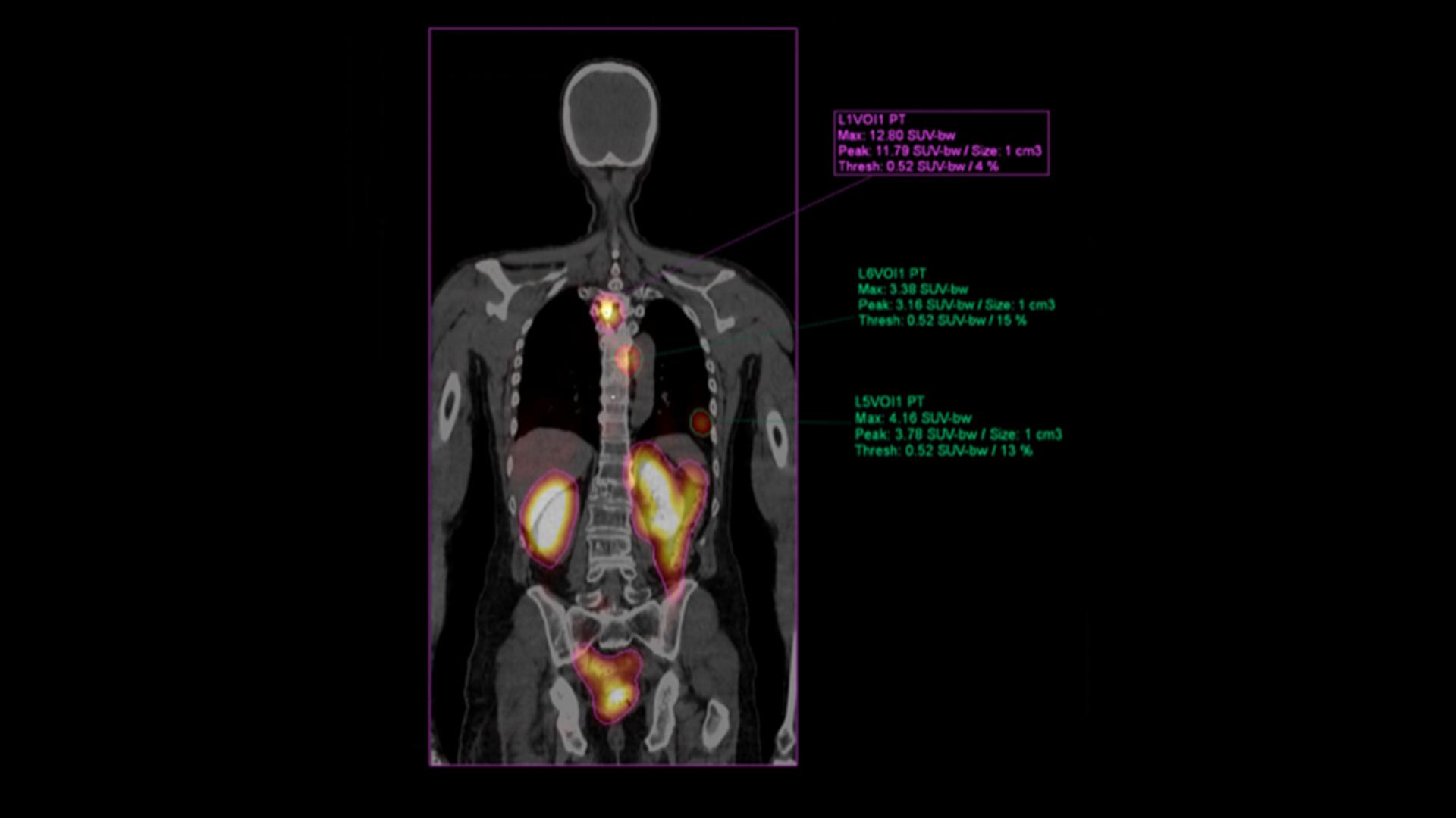 Symbia Intevo Bold SPECT/CT Scanner - Siemens Healthineers - Siemens ...