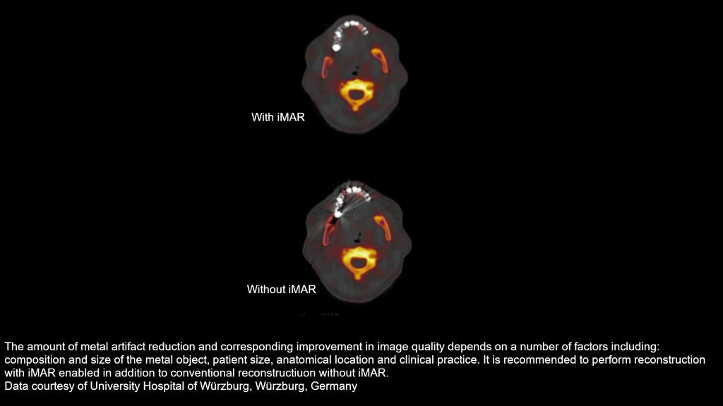 Symbia Intevo Bold SPECT/CT Scanner - Siemens Healthineers