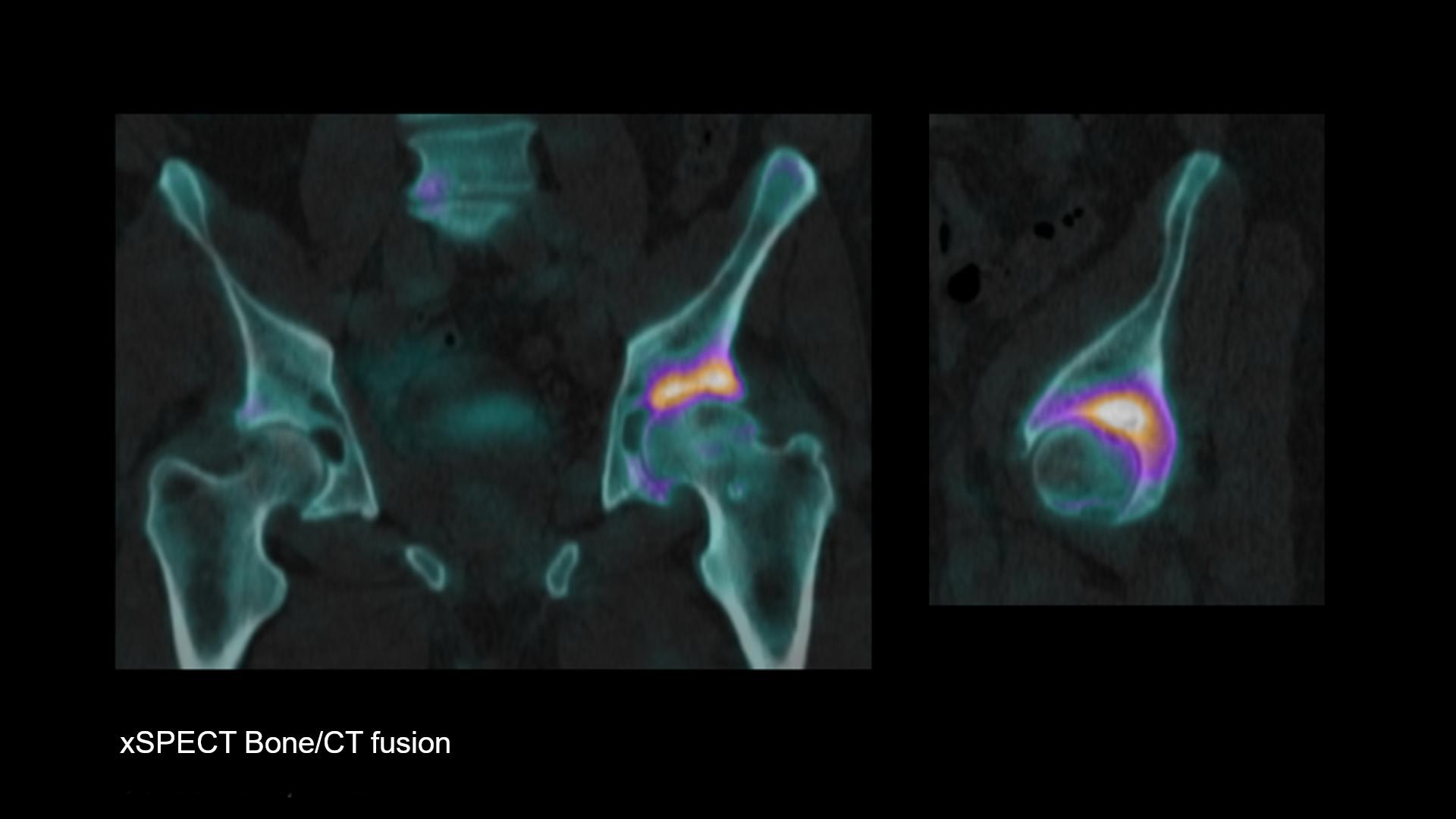 Symbia Intevo Bold - Siemens Healthineers Indonesia