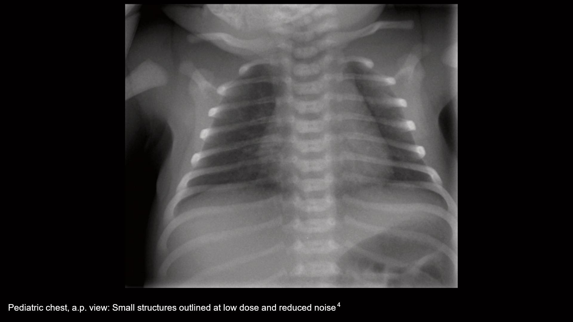 MOBILETT Elara Max - Siemens Healthineers USA