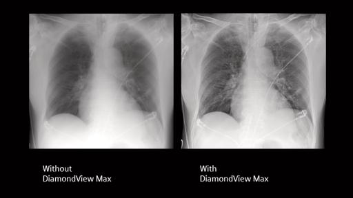 MOBILETT Elara Max - Siemens Healthineers USA
