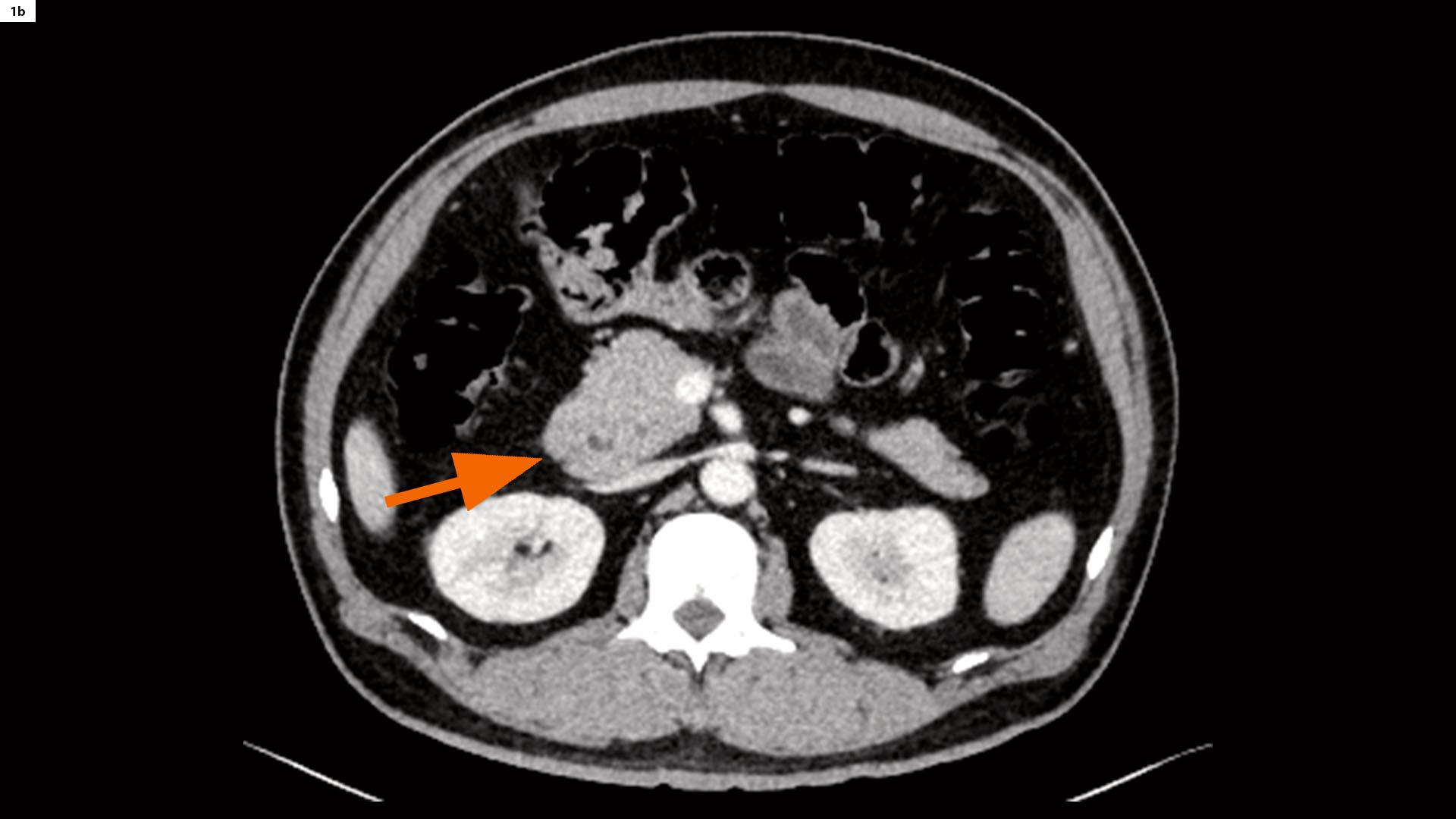 Annular Pancreas Accompanied by Hematochezia - Siemens Healthineers