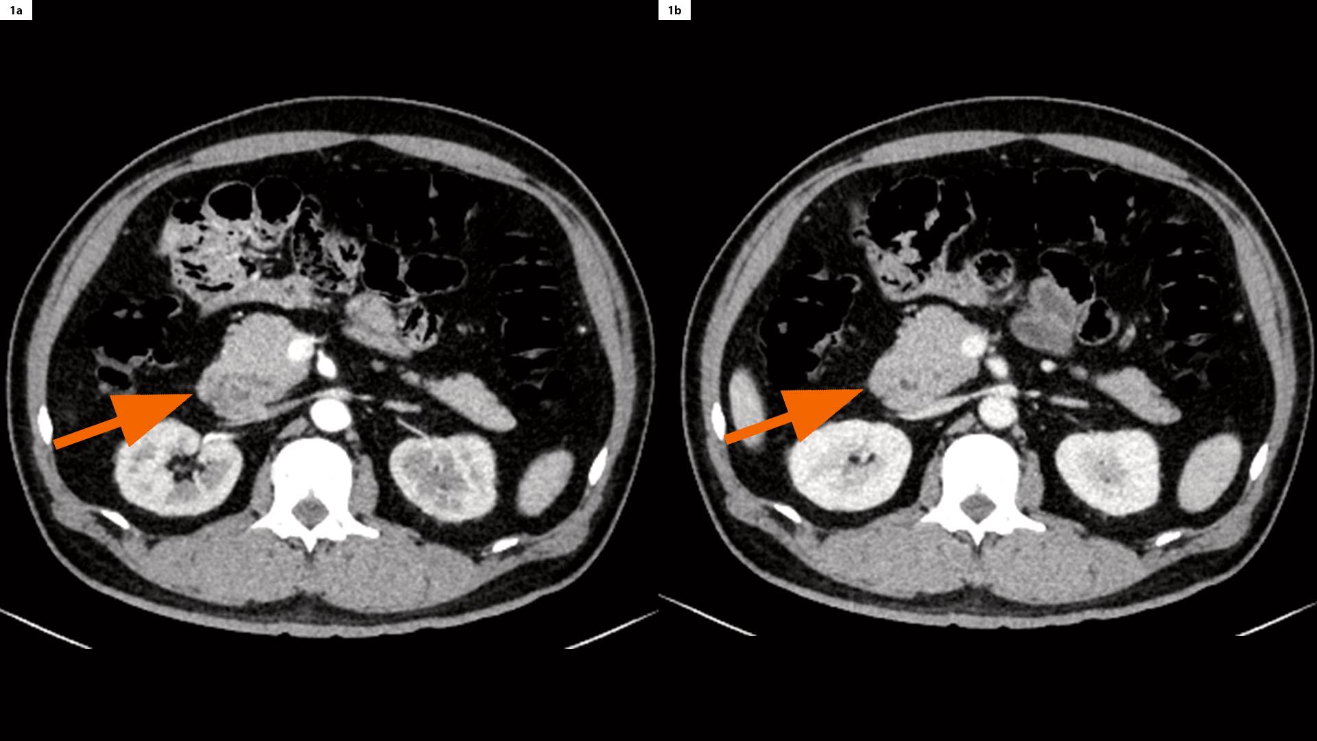 Annular Pancreas Accompanied by Hematochezia - Siemens Healthineers USA