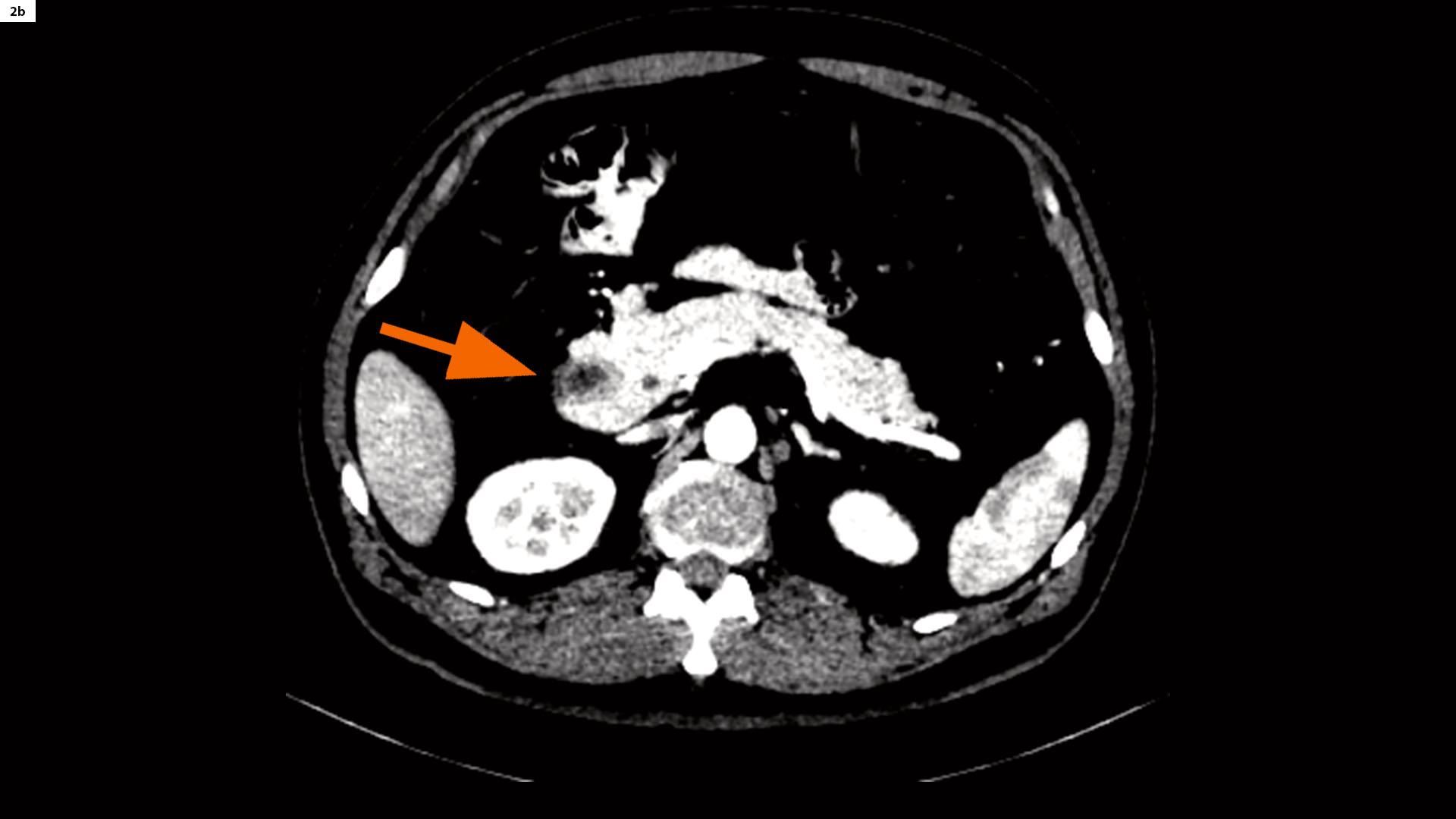 Annular Pancreas Accompanied by Hematochezia