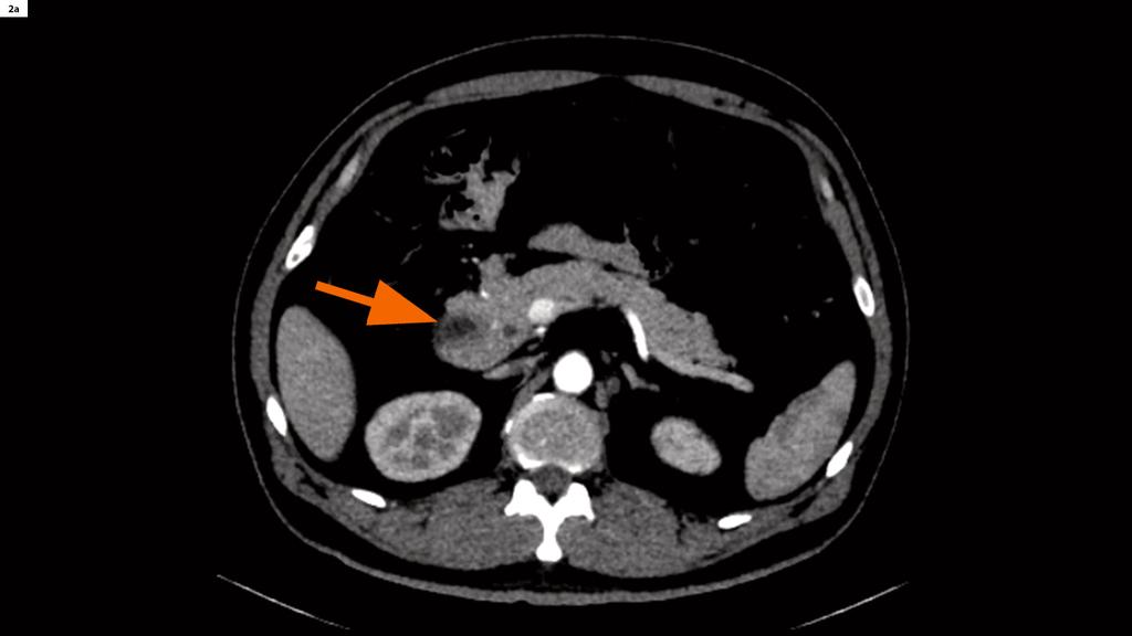 Annular Pancreas Accompanied by Hematochezia - Siemens Healthineers USA