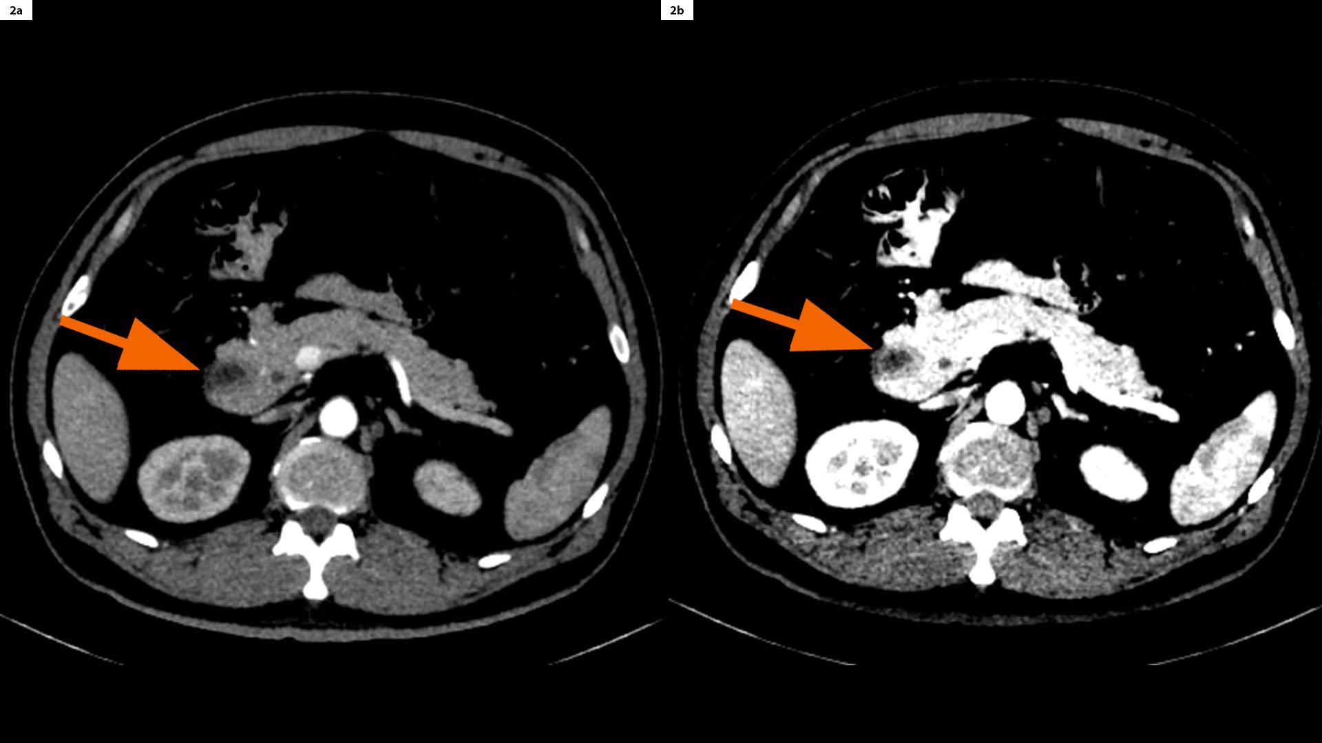 Annular Pancreas Accompanied by Hematochezia - Siemens Healthineers USA