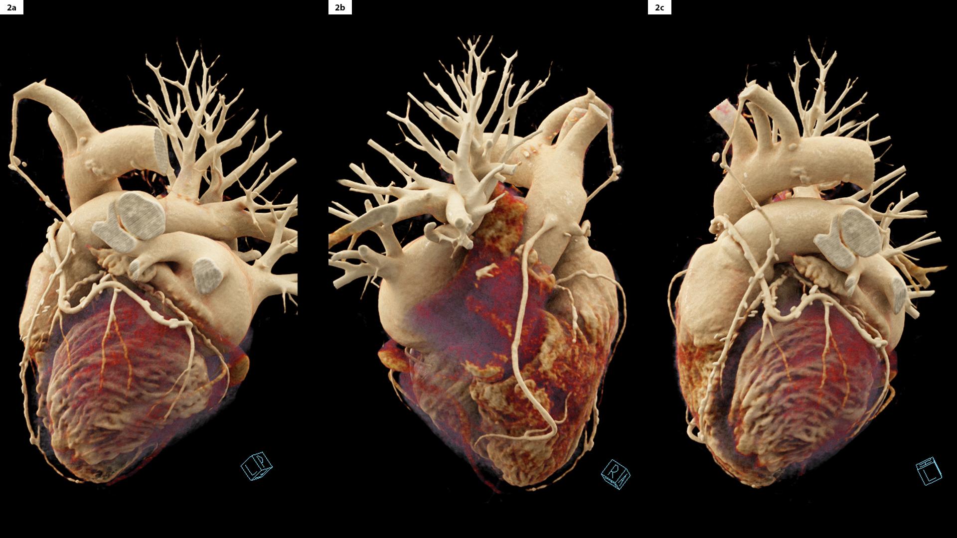 Sextuple Coronary Bypasses - Siemens Healthineers
