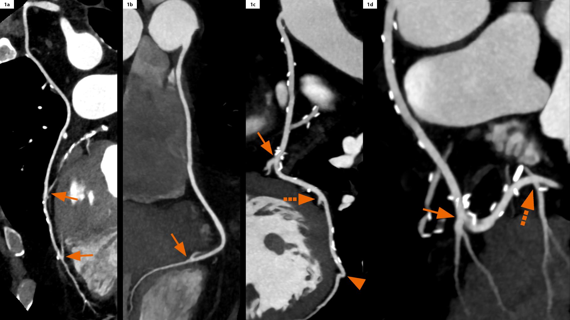 Sextuple Coronary Bypasses - Siemens Healthineers