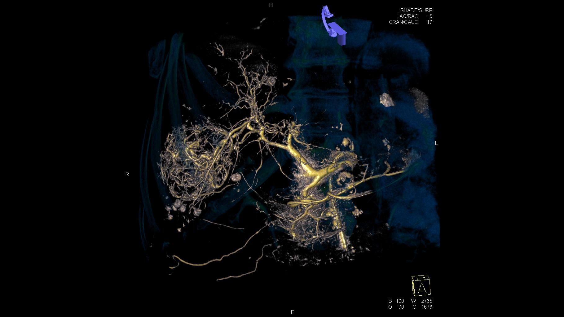 syngo DynaCT - Siemens Healthineers USA