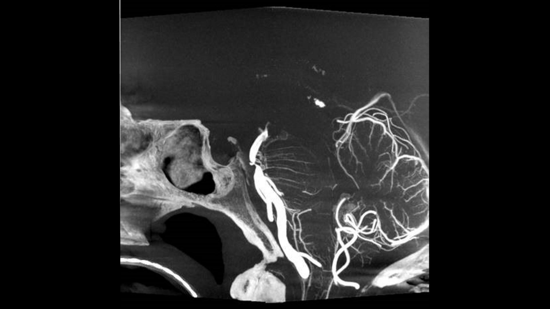 ARTIS icono - Siemens Healthineers Canada