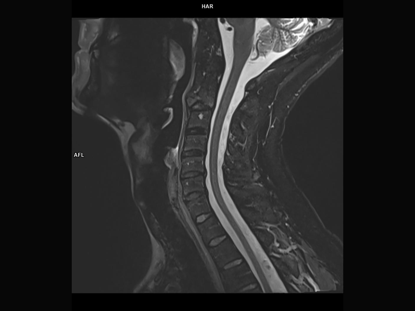 Sagittal STIR-MAGNETOM Vida - Siemens Healthineers USA