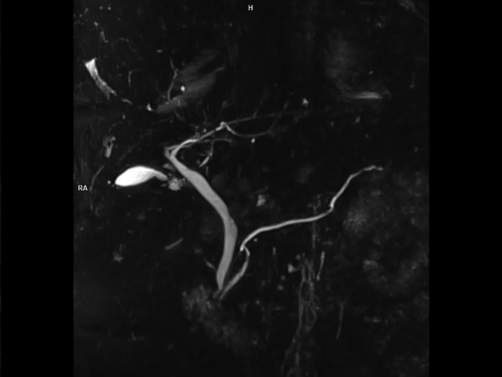 Cor T2 SPACE Resp Trigger MIP-MAGNETOM Vida - Siemens Healthineers USA