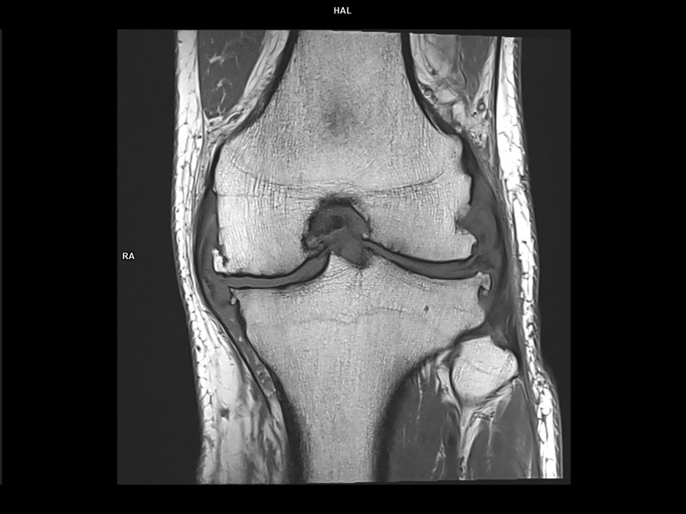 Coronal T1 TSE-MAGNETOM Vida - Siemens Healthineers USA