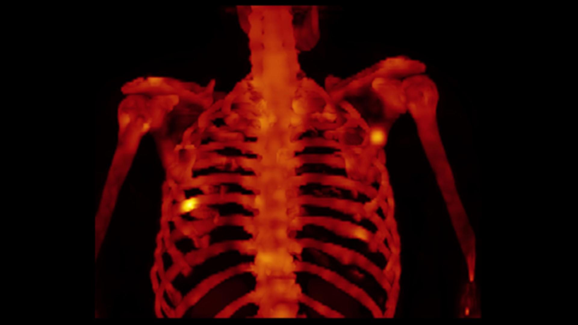 xSPECT Bone - Siemens Healthineers