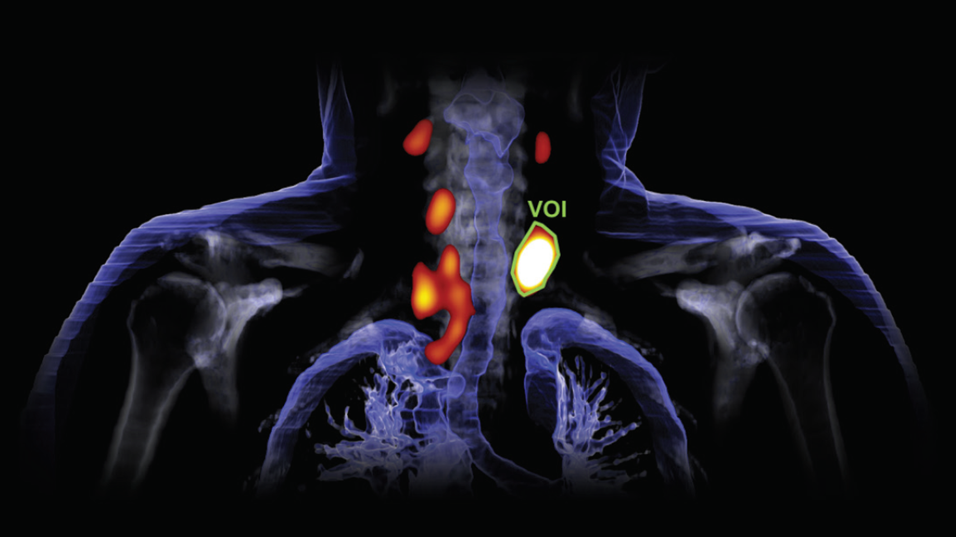 xSPECT Quant - Siemens Healthineers