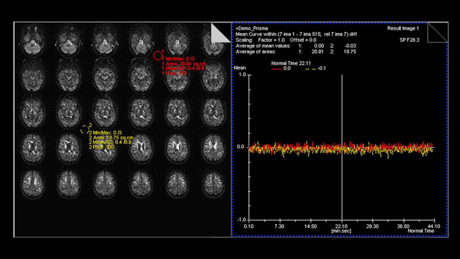 MAGNETOM Prisma - MRI Scanner - Siemens Healthineers