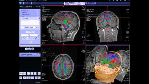 MAGNETOM Prisma - MRI Scanner - Siemens Healthineers