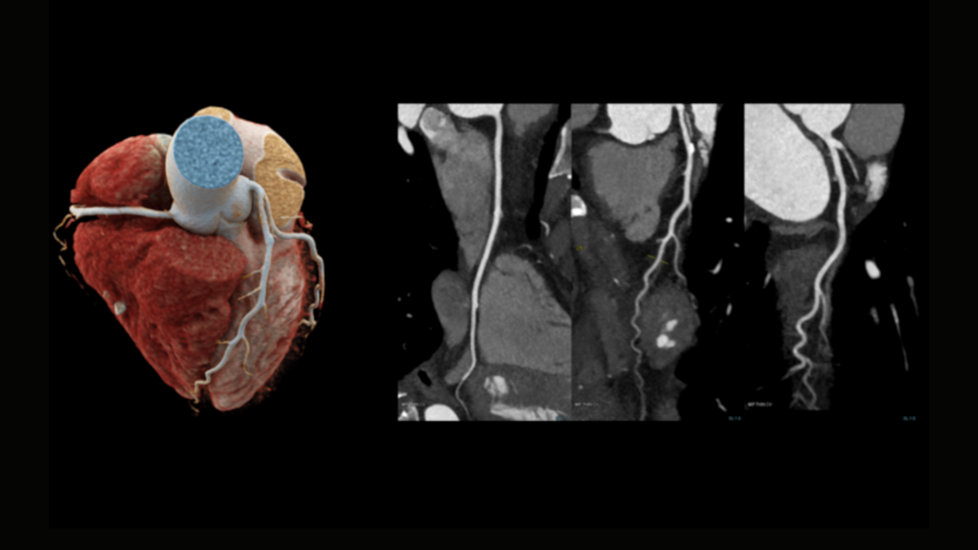 myExam Companion 搭載 Intelligent CT - SOMATOM X.cite - Siemens ...