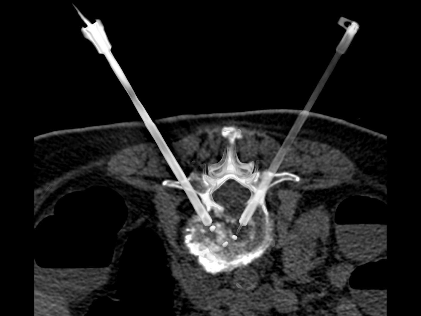CT-guided interventions - Siemens Healthineers