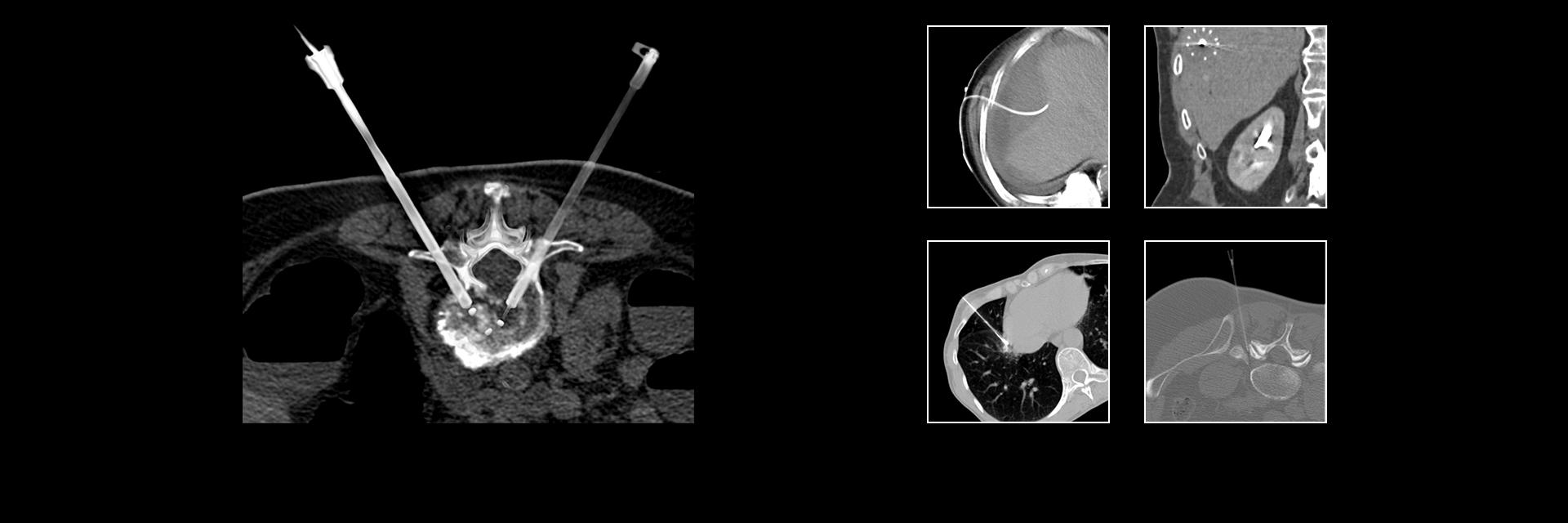 CT-guided interventions - Siemens Healthineers Polska