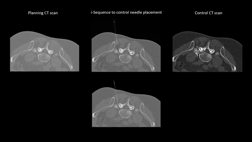 CT-guided interventional procedures - Siemens Healthineers