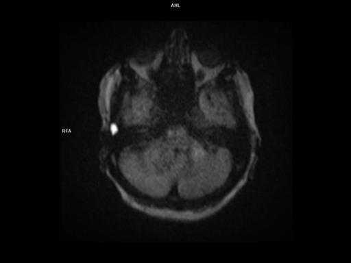 Axial HASTE Diffusion-MAGNETOM Altea - Siemens Healthineers USA