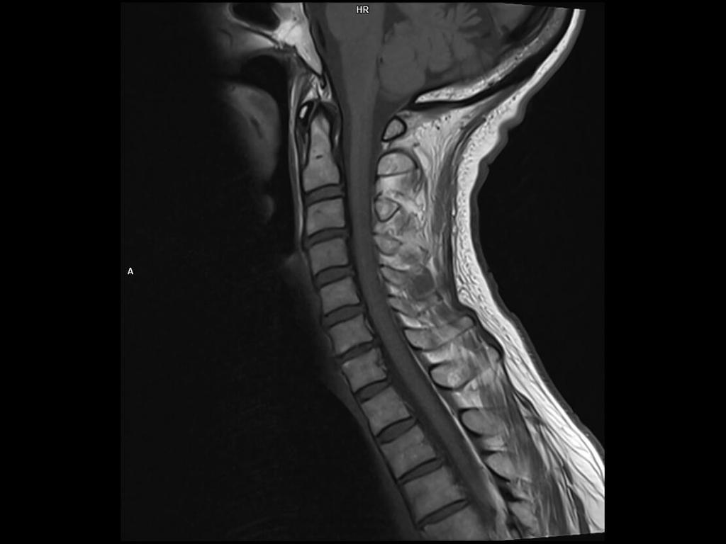 Sagittal T1 tse-MAGNETOM Altea - Siemens Healthineers USA