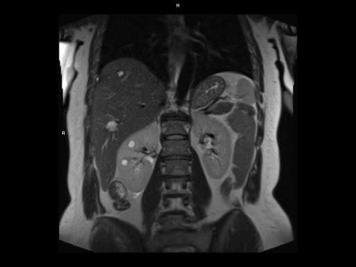 Coronal T2 HASTE low TE-MAGNETOM Sola - Siemens Healthineers USA