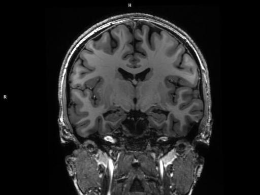 Coronal MPRAGE MPR-MAGNETOM Terra - Siemens Healthineers USA