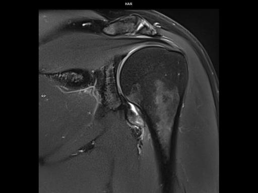 CORONAL T2 FS BLADE-MAGNETOM Vida - Siemens Healthineers USA