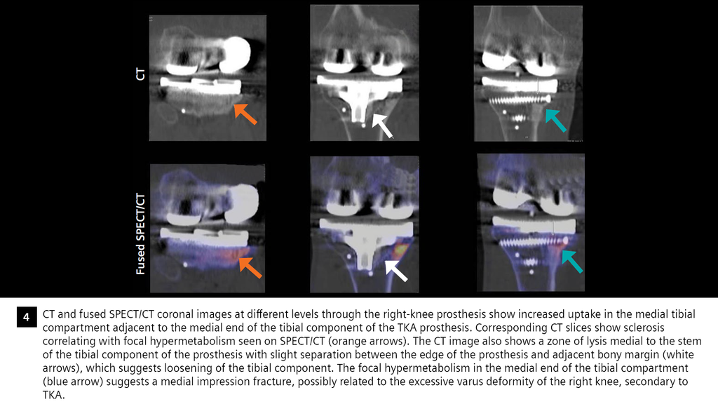 Loosening of tibial component of knee arthroplasty with medial ...